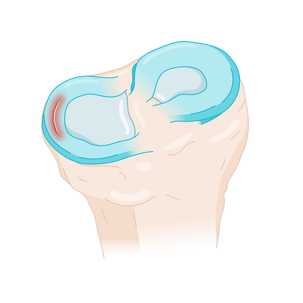 Déchirure du ménisque - Département femme-mère-enfant - CHUV
